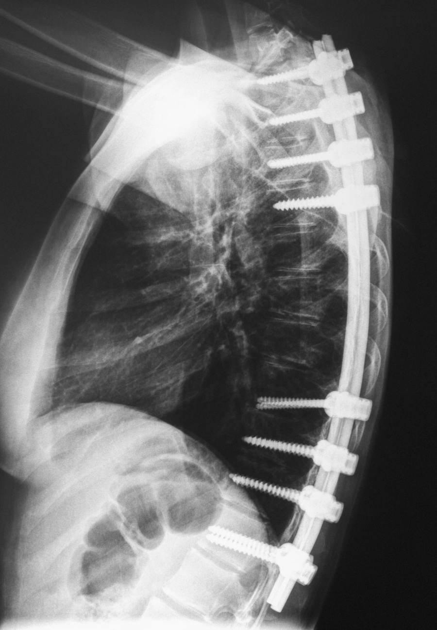 Types Of Orthopedic Implants Spectrum Orthopaedics types-of-orthopedic-implants-spectrum-orthopaedics