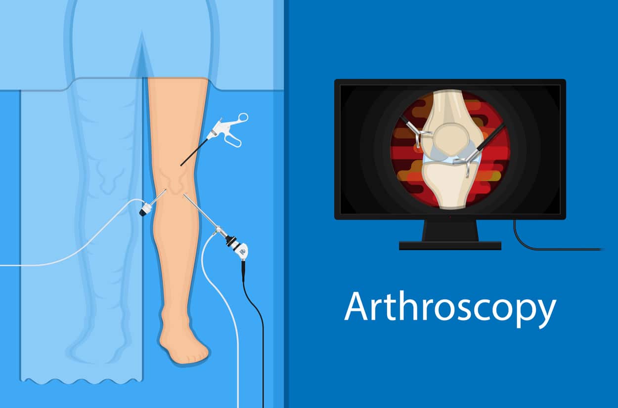Here’s What You Need to Know About Arthroscopic Surgery